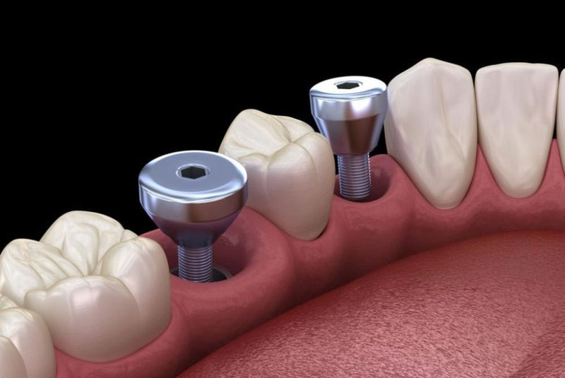 Healing Abutment vs Cover Screw: What You Need to Know