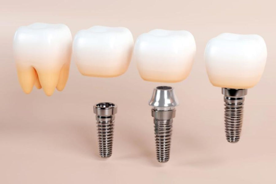 Different Types of Dental Implants Explained