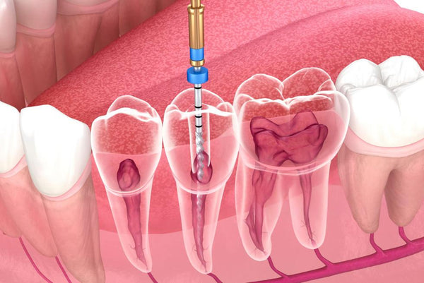 Endodontics: Complete Guide to Root Canal Therapy