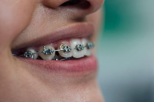 Buccal Tube: The Anchor for Your Braces